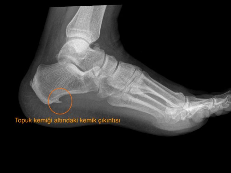 Topuk Dikeni Neden Olur? Nasıl Tedavi Edilir? – Op. Dr. Murat Kezer