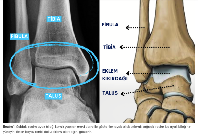 Ayak Bileği Kireçlenmesi – Op. Dr. Murat Kezer